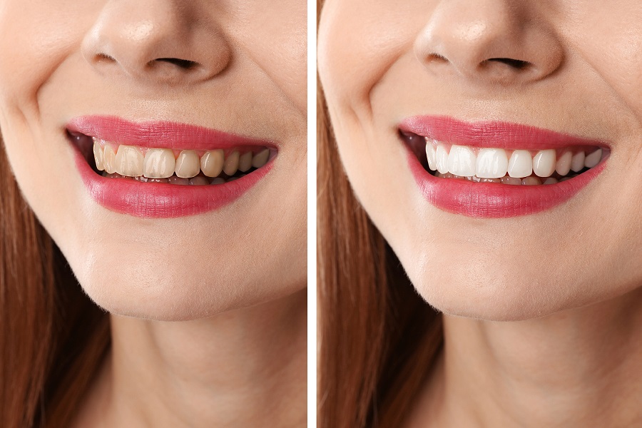 Teeth Whitening | Aaron E Slavsky DDS Lakewood, CO